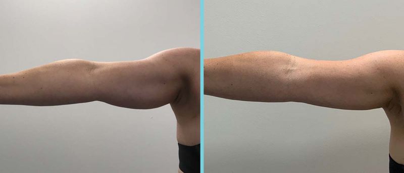 Vet bevriezen resultaat bij o.a. onderkin, buikvet, lovehandles